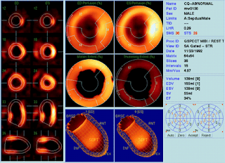 Myocardial Perfusion Scan (MPS) | Know Nuclear Medicine