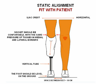 osteo support: TRANS-TIBIAL STATIC ALIGNMENT