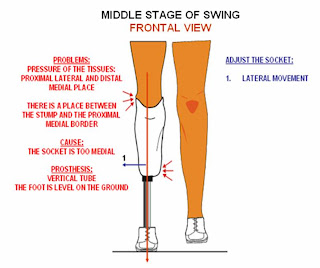 osteo support: TRANS-TIBIAL DYNAMIC ALIGNMENT