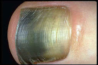 Health Raaz: Pseudomonas Infection