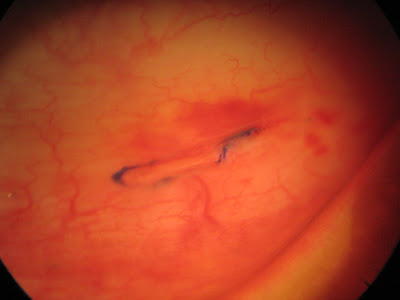 Take Care Of Your Eyes: Conjuctival Tear