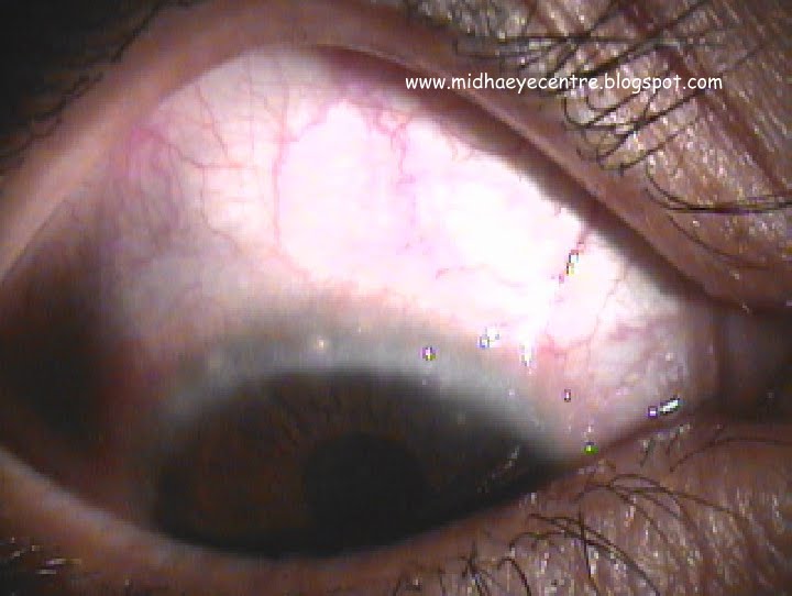 Take Care Of Your Eyes: Vernal Keratoconjunctivitis