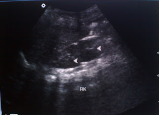 IRRADIATED - Radiology: URETEROCELE - A CASE REPORT