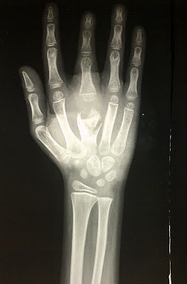 IRRADIATED - Radiology: Tuberculous Dactylitis – Spina Ventosa
