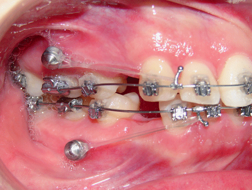 GICAI, "Creadores de Sonrisas": Microimplantes o Mini implantes en ...