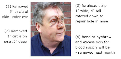 Forehead Flap Surgery - BCC