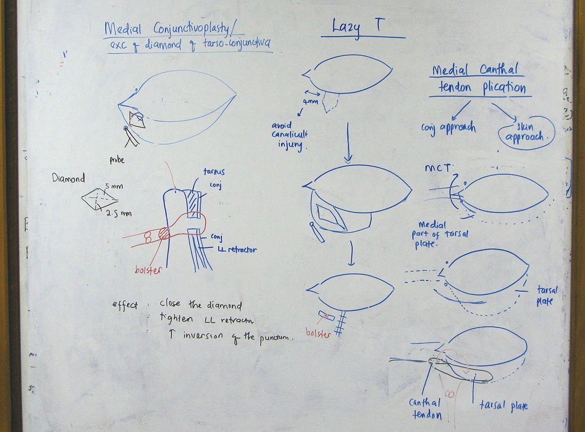 UKM Ophthal Part 2 2010: Ectropion