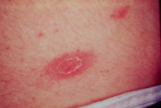 Epidemiologia Escobar: Pitiriasis Rosada de Gilbert - Epidemiologiaescobar