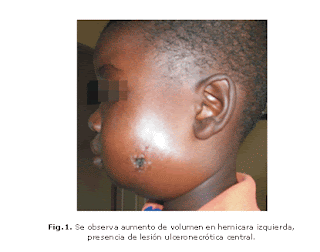 Epidemiologia Escobar: CARBUNCO (ANTRAX) - Lo que debe saber ...