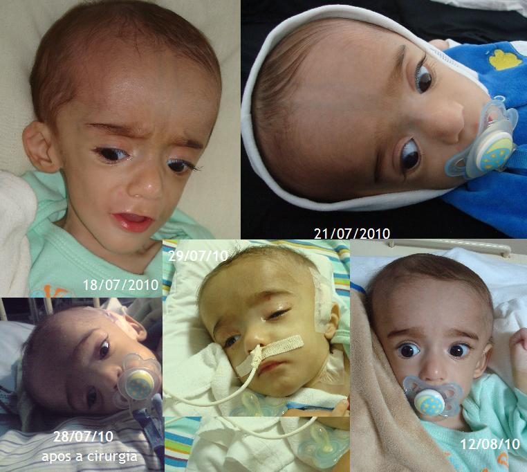 uma história de verdade: A Evolucao e a Hidrocefalia