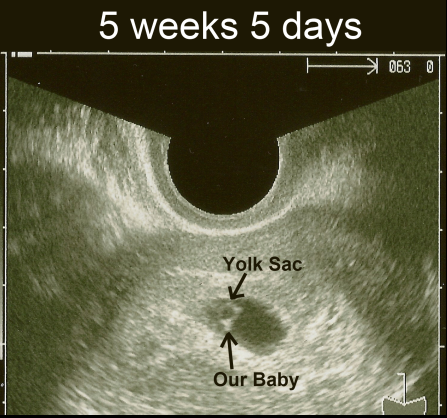 Mommy in the Making: First Ultrasound! 5 weeks 5 days