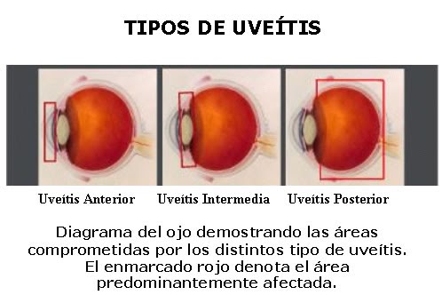 Utópica Ataraxia: (Uveitis Anterior Aguda)