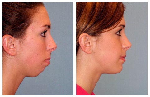 Plastic Surgery Before And After: Chin Augmentation Before And After
