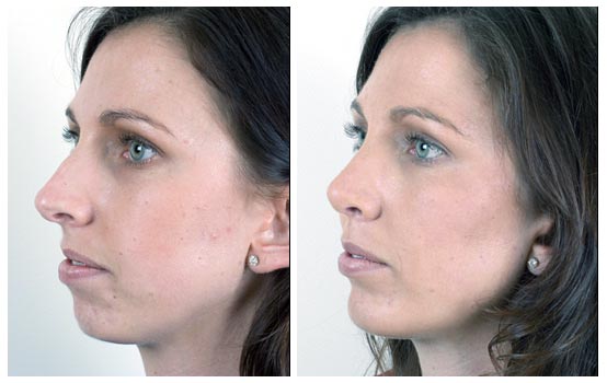 Plastic Surgery Before And After: Chin Implant Before And After