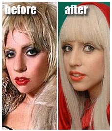 Plastic Surgery Before And After: Lady Gaga Plastic Surgery
