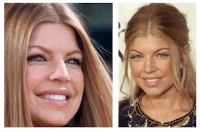Plastic Surgery Before And After: Fergie Plastic Surgery