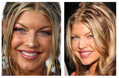 Plastic Surgery Before And After: Fergie Plastic Surgery