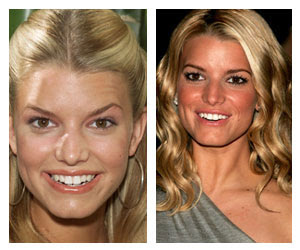 Plastic Surgery Before And After: Jessica Simpson Plastic Surgery