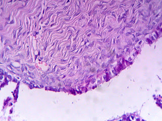 HISTOPATHOLOGY: Paraovarian cyst