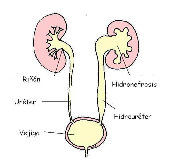 Hidronefrosis, hidrouréter y ureterohidronefrosis