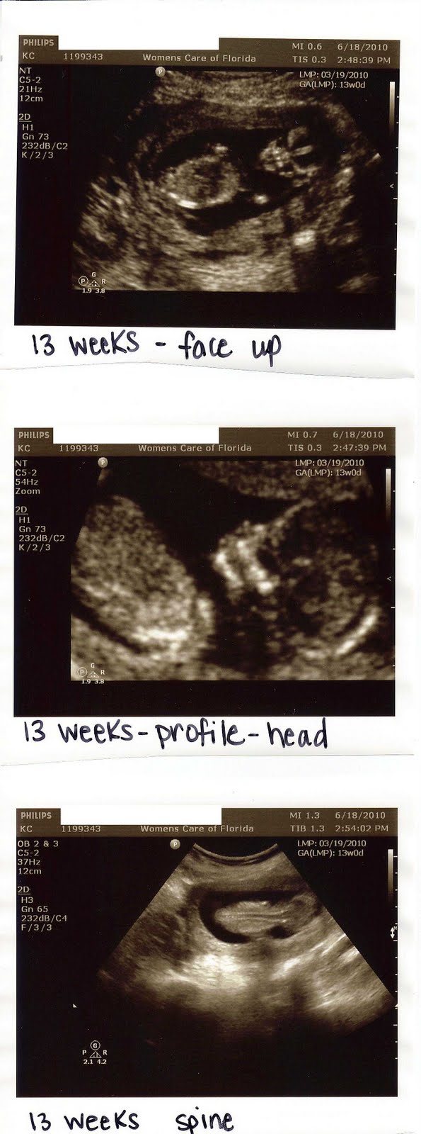 Delivery Girl: NT scan 13 weeks