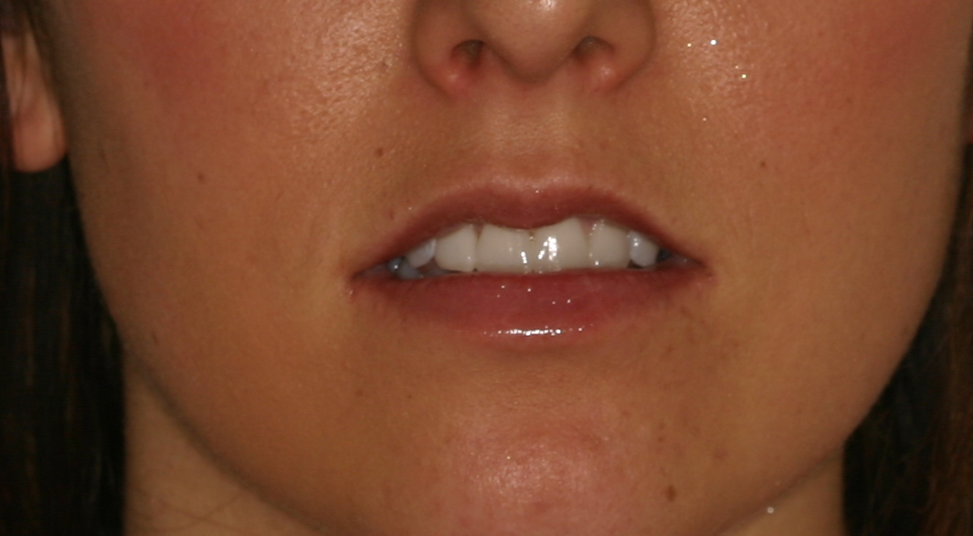 Beautiful Smiles Aesthetic Smile Make Over With Tissue Re Contouring