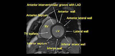 MRI BLOG: Cardiac Anatomy