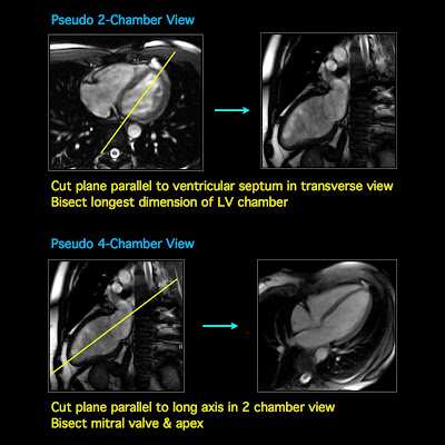 MRI BLOG: Cardiac MRI - Imaging Planes for Basic Cardiac Views