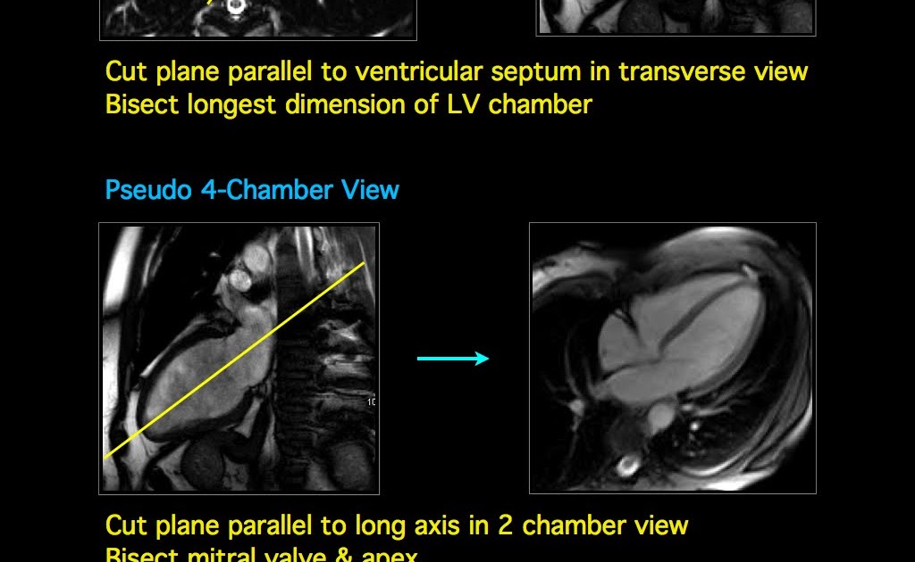 MRI BLOG: Cardiac MRI - Imaging Planes for Basic Cardiac Views