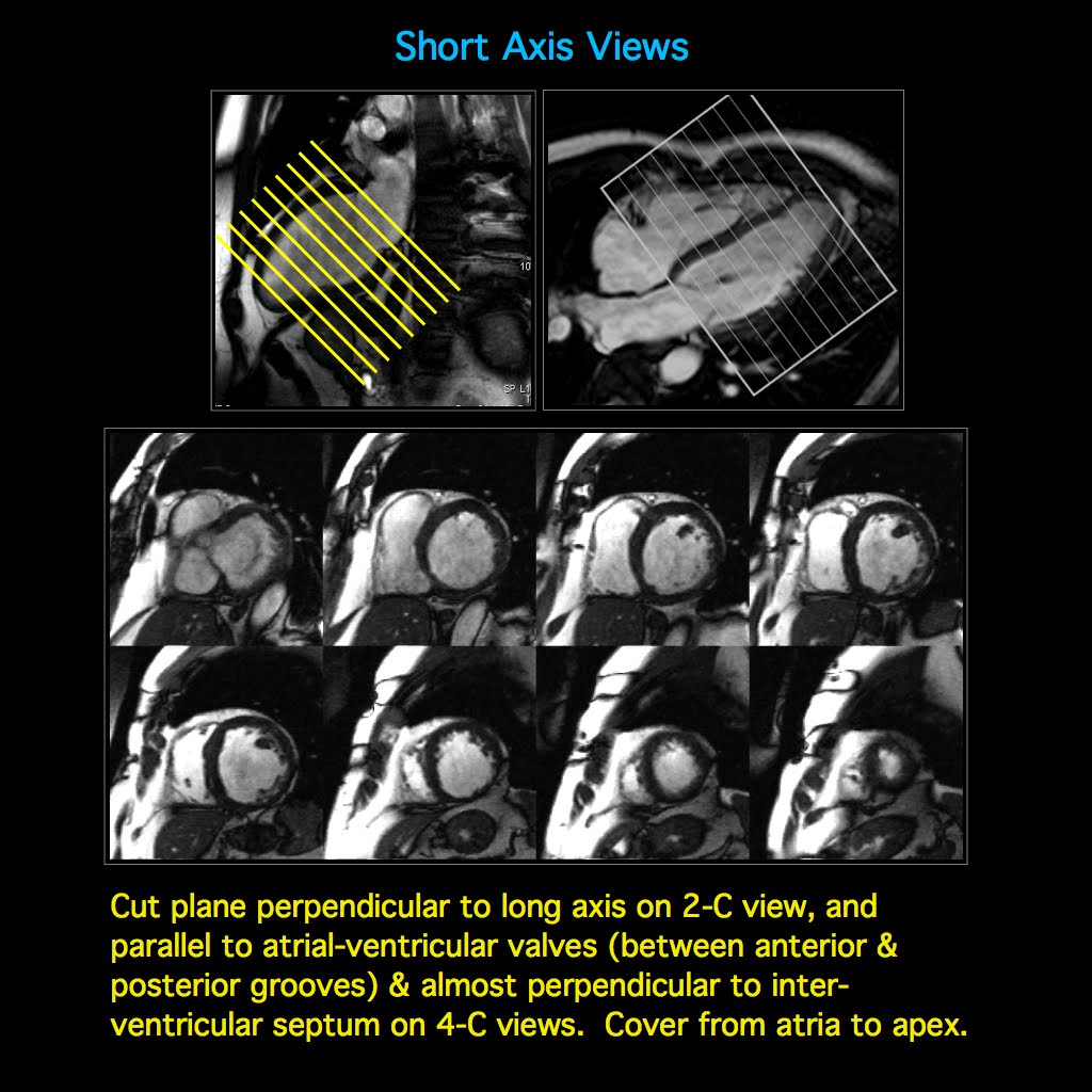 MRI BLOG: Cardiac MRI - Imaging Planes for Basic Cardiac Views