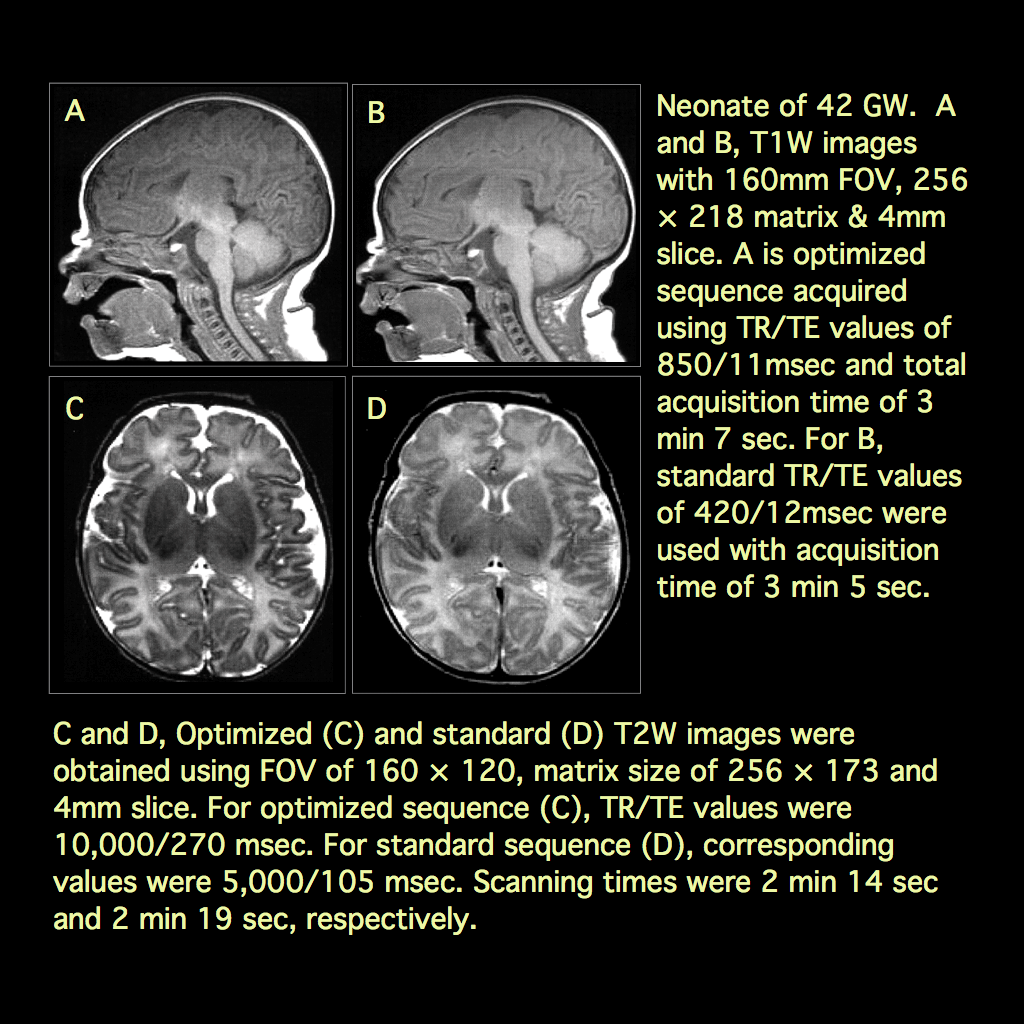 MRI BLOG: Brain MRI - Neonates