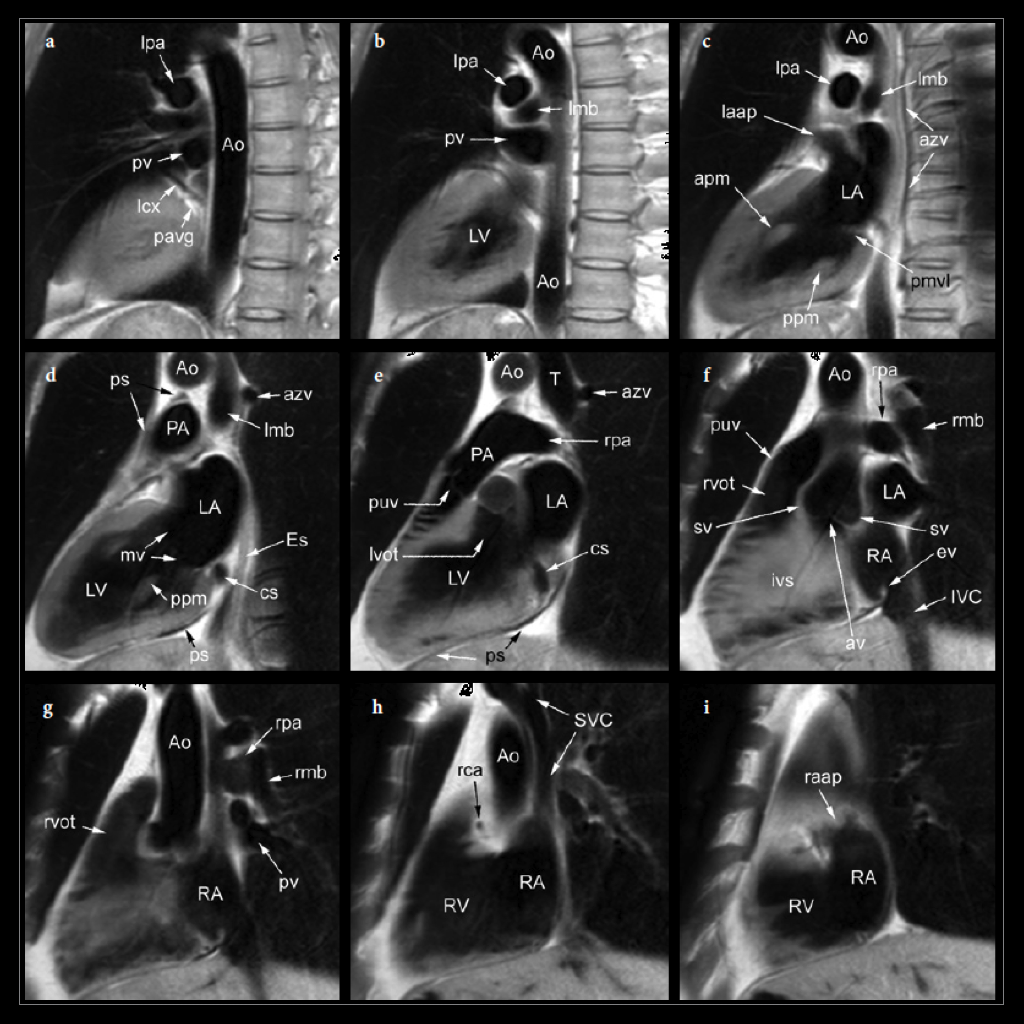 MRI BLOG: Detailed CMR Anatomy