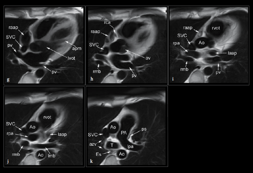 MRI BLOG: Detailed CMR Anatomy