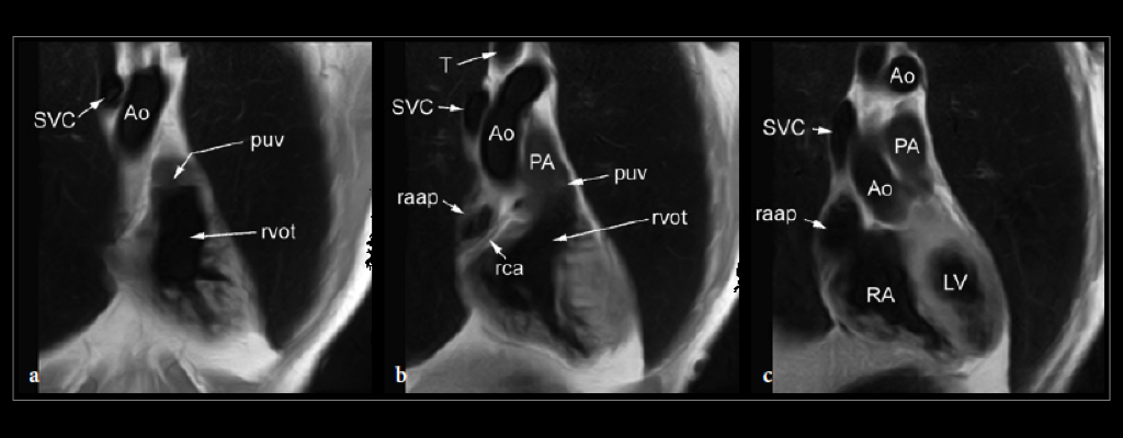 MRI BLOG: Detailed CMR Anatomy
