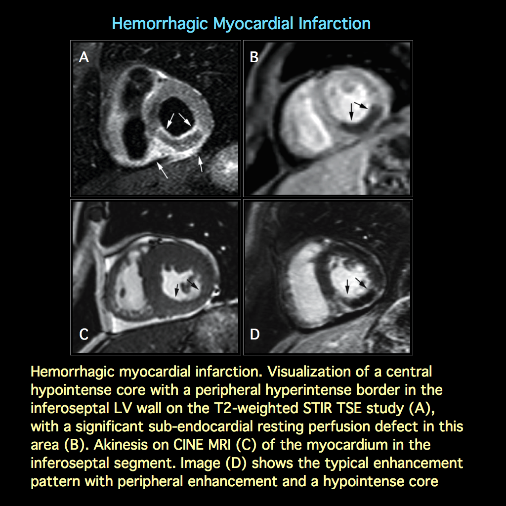MRI BLOG: Imagery of Cardiac Pathology