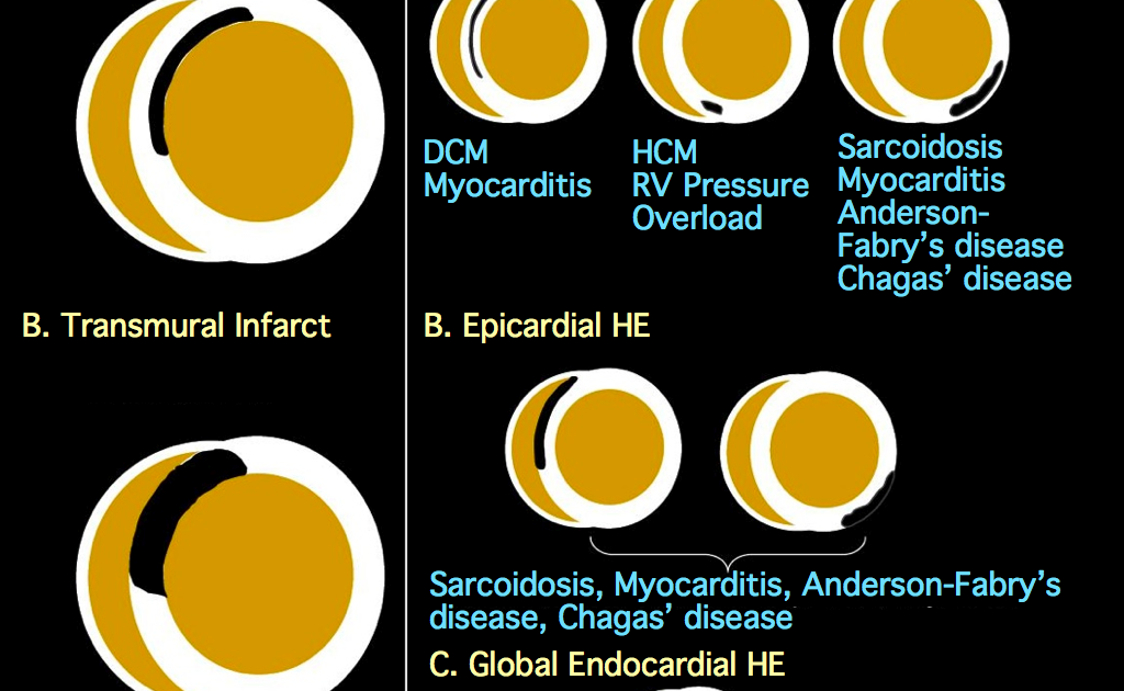 MRI BLOG: Delayed Hyper-enhancement (HE) Patterns in CMR