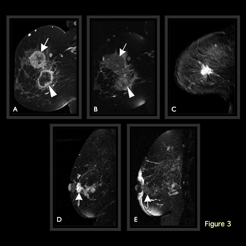 MRI BLOG: Breast MRI