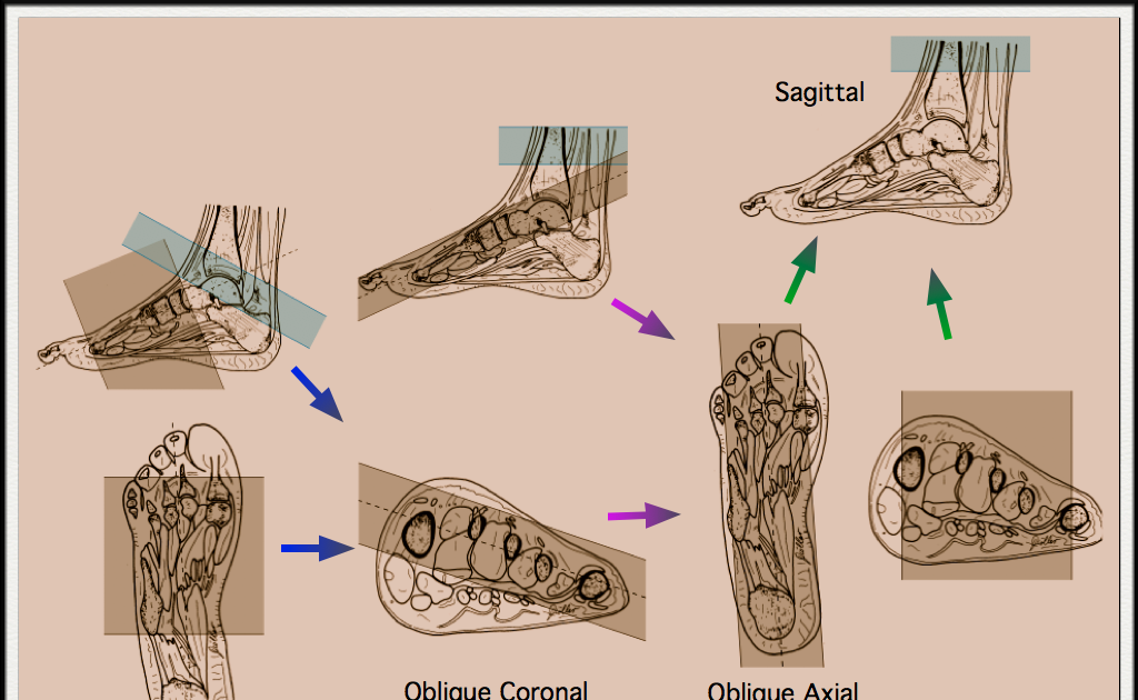 MRI BLOG: Foot (Midfoot) MRI