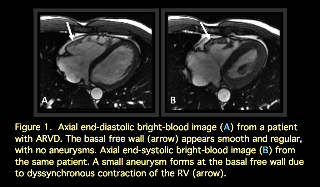 MRI BLOG: Arrhythmogenic Right Ventricular Dysplasia/Cardiomyopathy ...