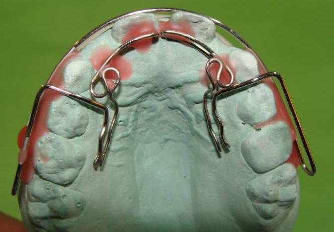 Ortodoncia Tecnica: primer klammt tipo I