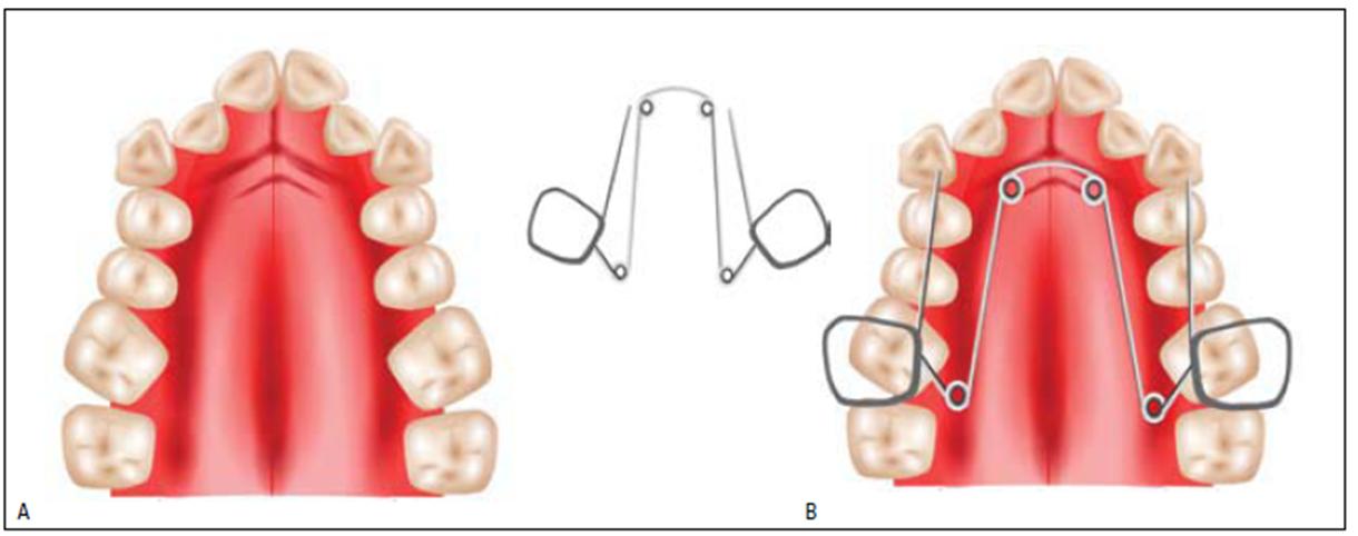ORTODONTIA CONTEMPORÂNEA: O aparelho quadrihélice (Quad-helix) e suas ...