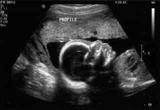 Merland: 20 Week Level II Ultrasound