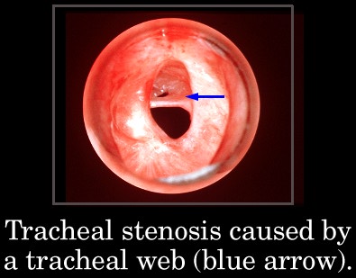 Doctors Gates: Picture of Congenital Subglottic Stenosis