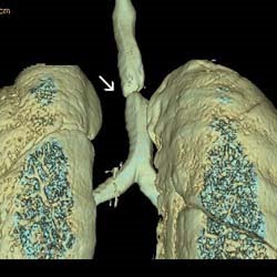 Doctors Gates: Tracheal Stenosis