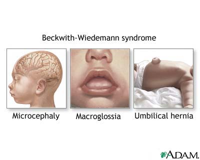 Doctors Gates: Beckwith-Wiedemann Syndrome (BWS)
