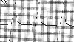 Doctors Gates: ECG changes in Hyperkalemia