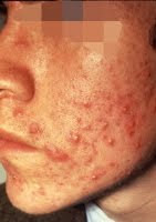Doctors Gates: Acne Vulgaris