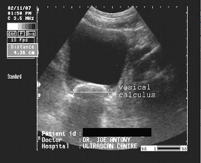 ON - RADIOLOGY: Large urinary bladder calculus (by Pie Scanner 100 ...