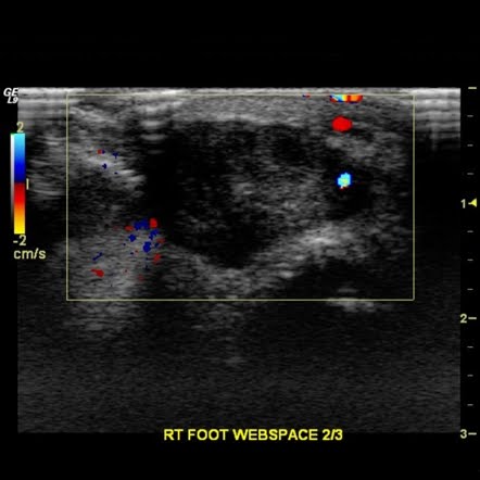 Doctors Gates: Giant cell tumour of the tendon sheath
