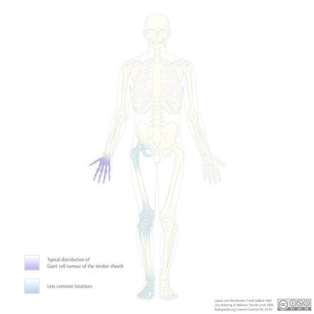 ON - RADIOLOGY: Giant cell tumour of the tendon sheath